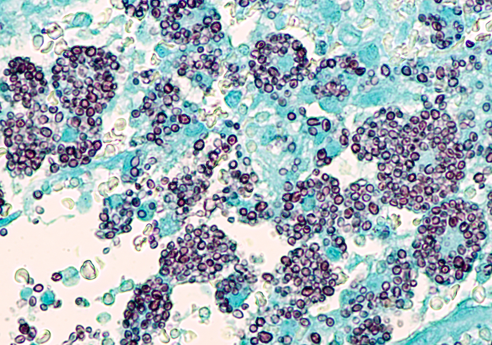Microscopic,Of,Disseminated,Histoplasmosis,,A,Type,Of,Fungal,Infection ...